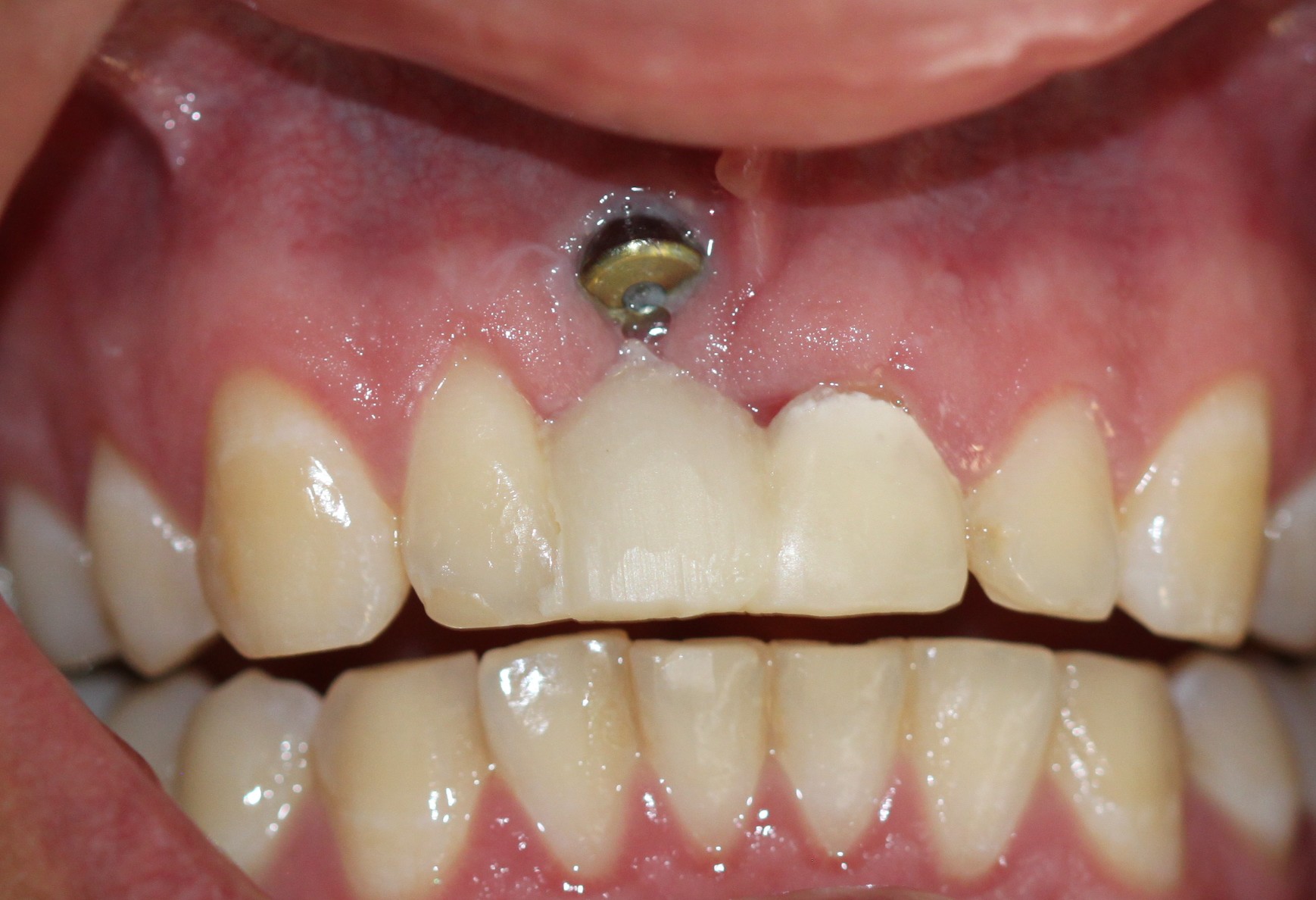 Desastres en implantología oral – Dentista y Paciente