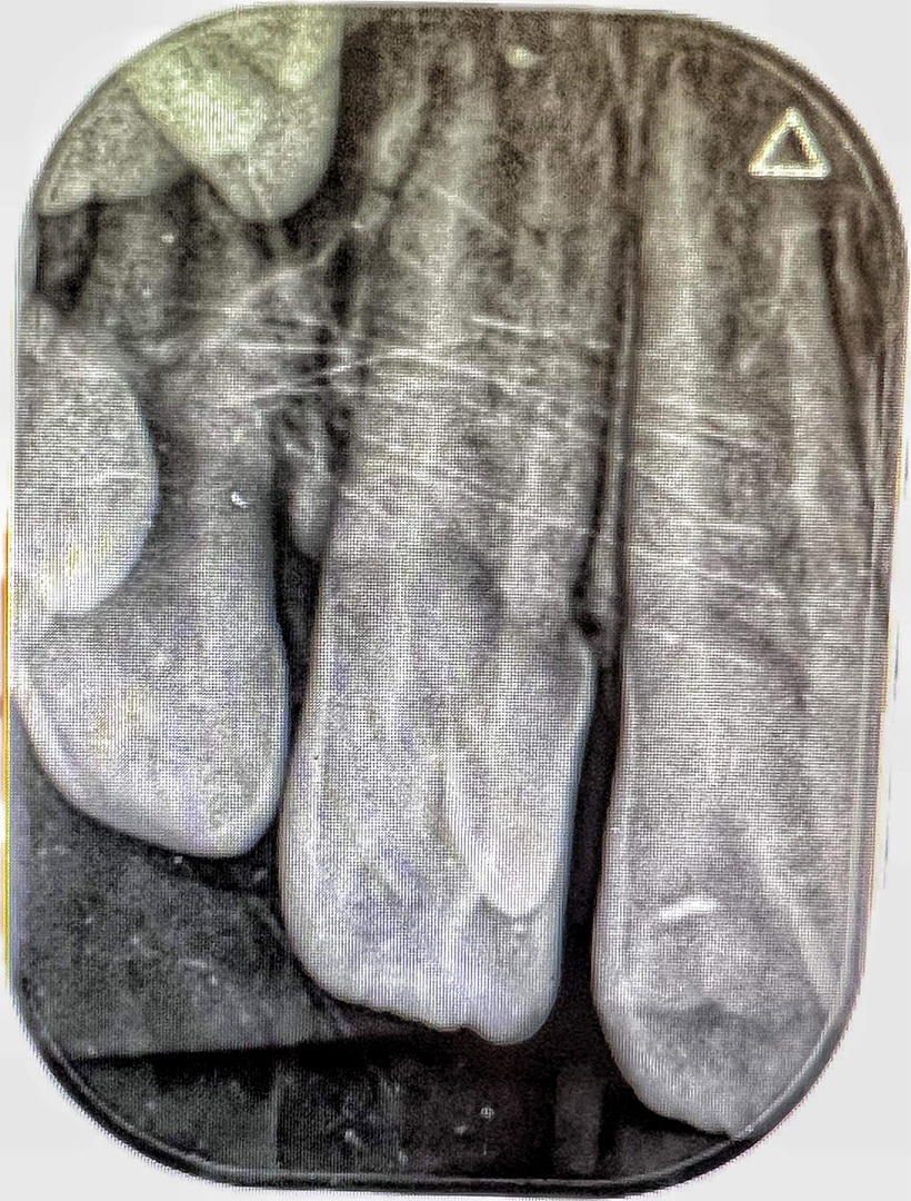 Talón Cuspídeo. Reporte de caso clínico – Dentista y Paciente